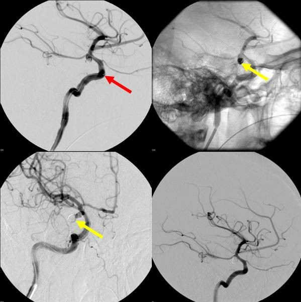Aneurysmen: Uniklinik Mannheim